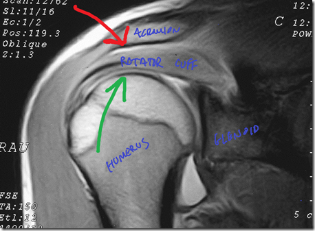 Understanding Shoulder Impingement Etiology
